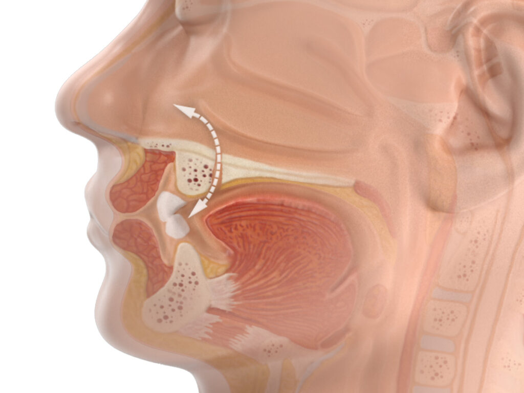 After Extraction of Wisdom Teeth Paris, Texarkana TX | Dry Socket
