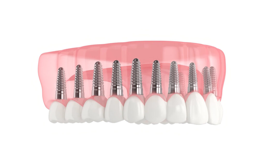 Full Mouth Dental Implants Texarkana, Paris TX | Full Arch Teeth Implants