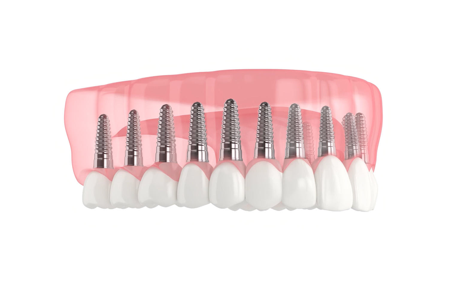 Full Mouth Dental Implants Texarkana, Paris TX | Full Arch Teeth Implants